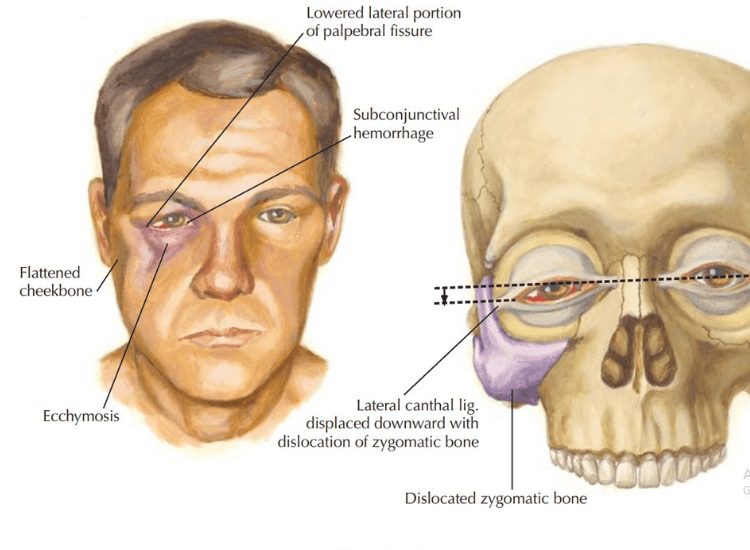 Facial Fractures - Maxillofacial